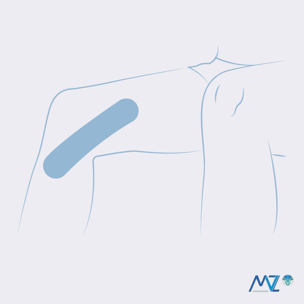 Knie tapen: Einfache Tipps vom Experten